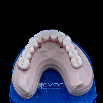 Implant Supported Prosthesis – Evoq DDS