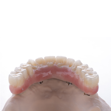 Implant Supported Prosthesis – Evoq DDS